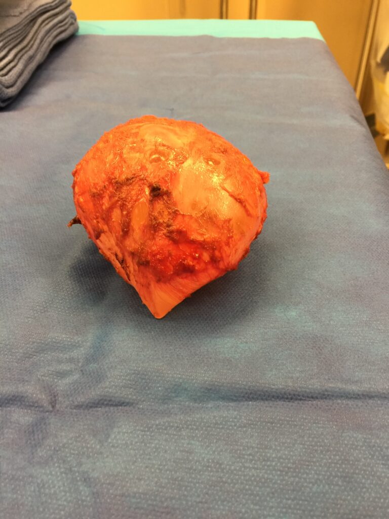 En Bloc Capsulectomy in Minneapolis St. Paul MN